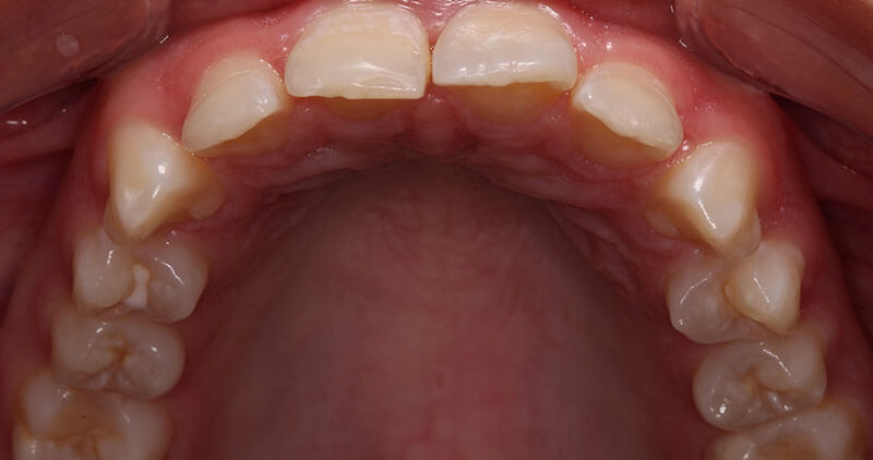 Orthodontics Dentistry Gallery – Picnic Point Dental