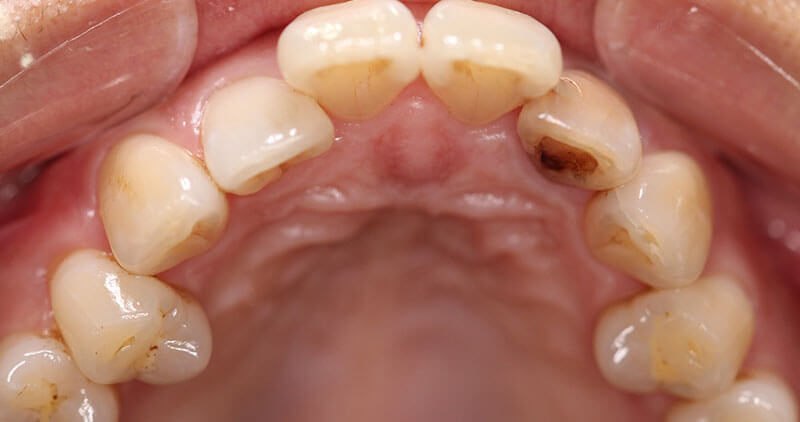 Orthodontics Dentistry Gallery – Picnic Point Dental